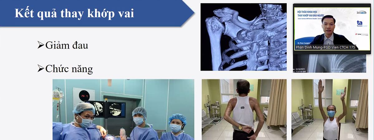 Scientific Seminar on SMR® Reverse Shoulder with live surge...